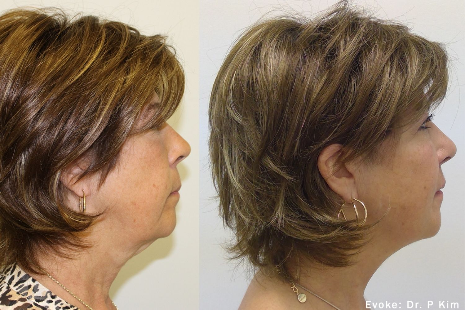 Evoke | Non-Surgical Facelift | Lumiere Med Spa