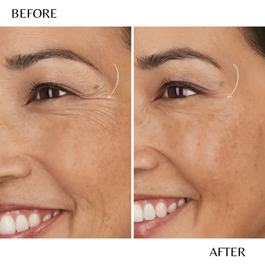 Treatment of Crow's Feet Wrinkles - Medical Spa Botox Laser Hair Skin Rejuvenation