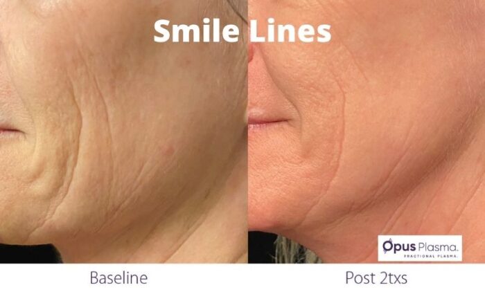 Opus Plasma | Non-Surgical Skin Treatment - Medical Spa Botox Laser ...