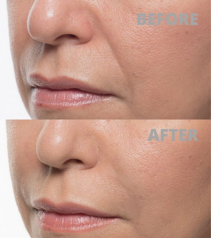 Injectable Dermal Fillers in South Jersey - Lumiere Med Spa
