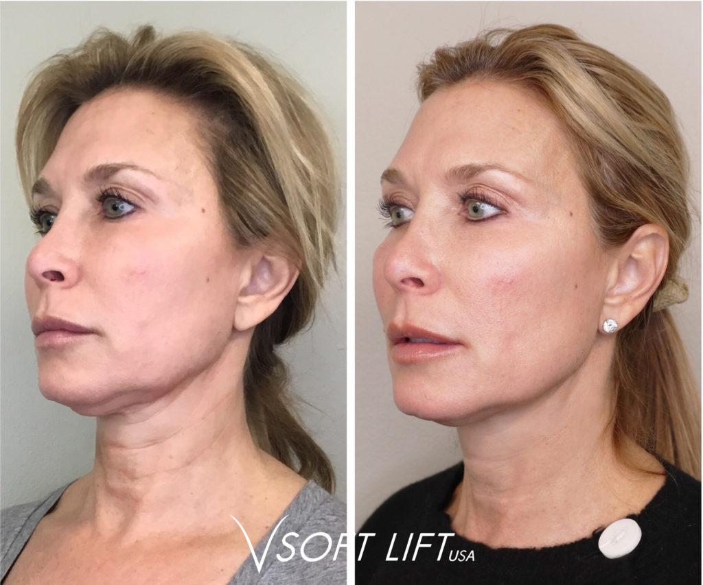 What Is A Thread Lift Treatment For Lines And Wrinkles 